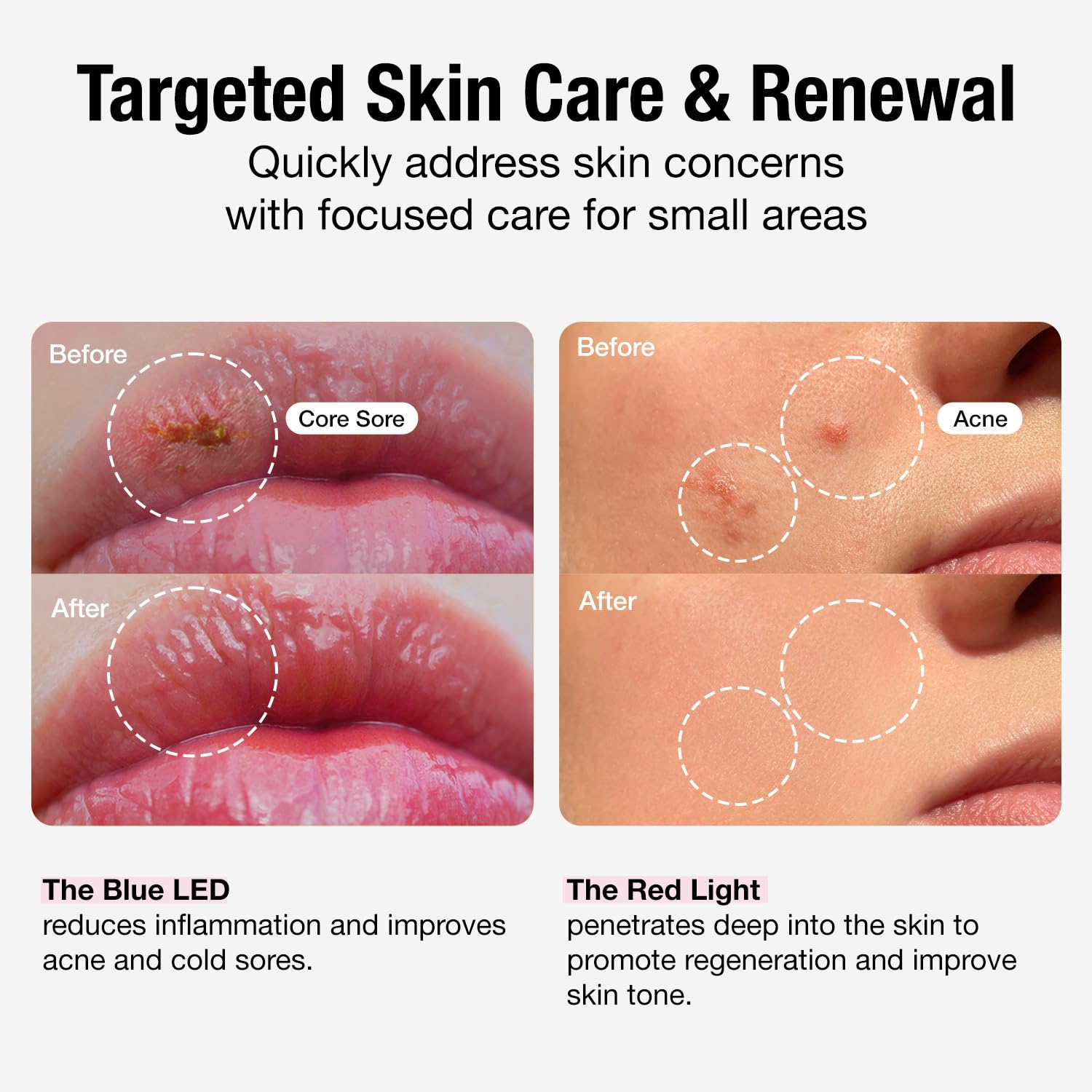 Infrared Red Light Therapy Device for Face Cold Sores, Joint Pain ...